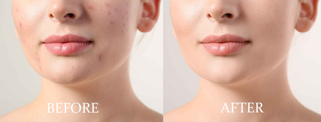 Skin Acne & Blemishes – Prédiré Paris